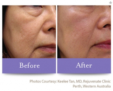 Before & After | Skin Remodeling San Anselmo | Facial Rejuvenation San ...