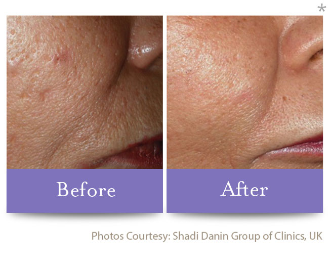 Before & After | Skin Remodeling San Anselmo | Facial Rejuvenation San ...