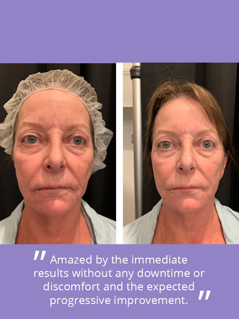 Skin Tightening and Rejuvenation - Harmony XL Pro Treatments ...