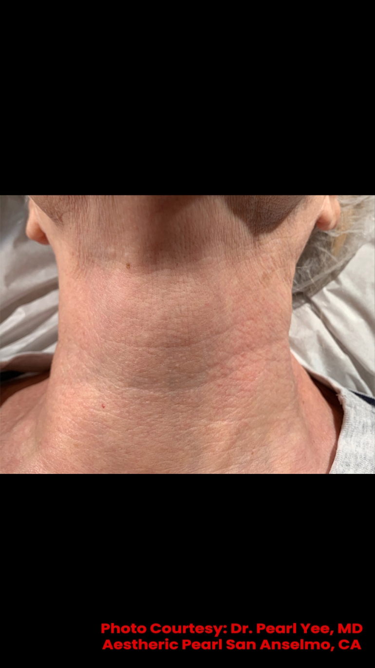 Skin Tightening and Rejuvenation - Harmony XL Pro Treatments ...