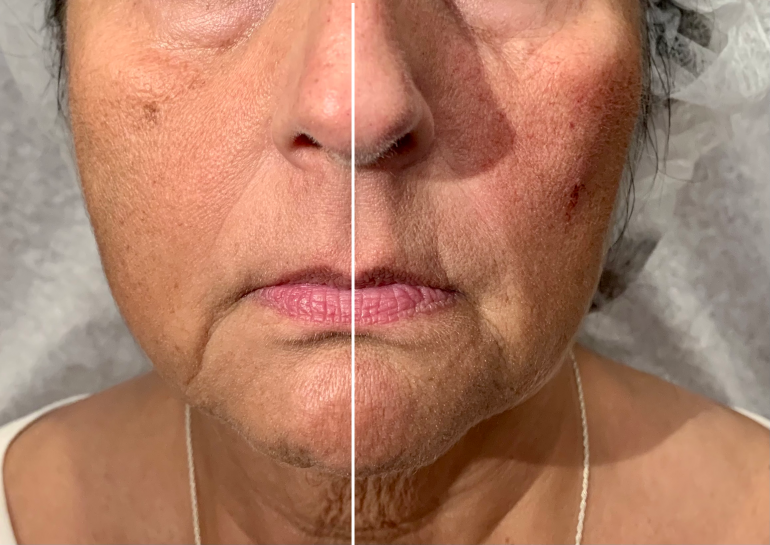 Botox and Fillers - Harmony XL Pro Treatments | Aesthetic Pearl