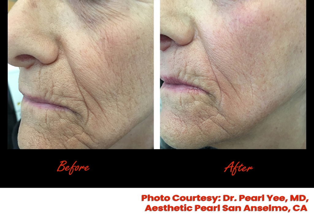Before & After | Skin Remodeling San Anselmo | Facial Rejuvenation San ...