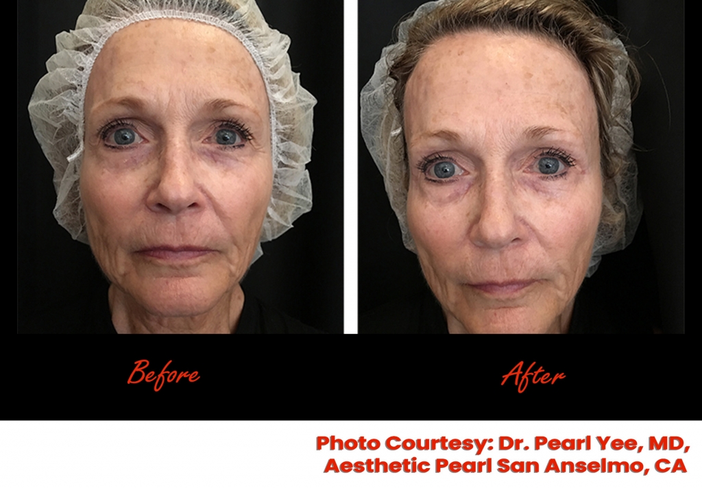 Before & After | Skin Remodeling San Anselmo | Facial Rejuvenation San ...