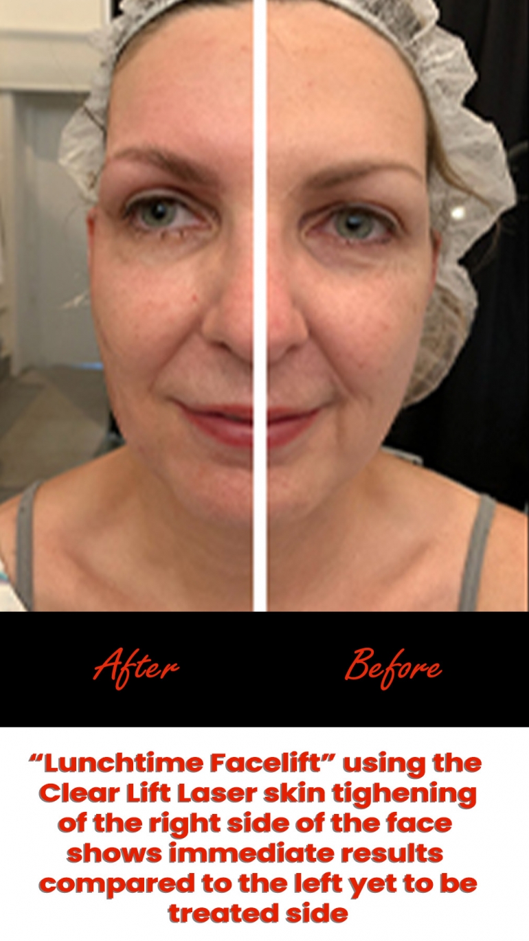 Before & After | Skin Remodeling San Anselmo | Facial Rejuvenation San ...