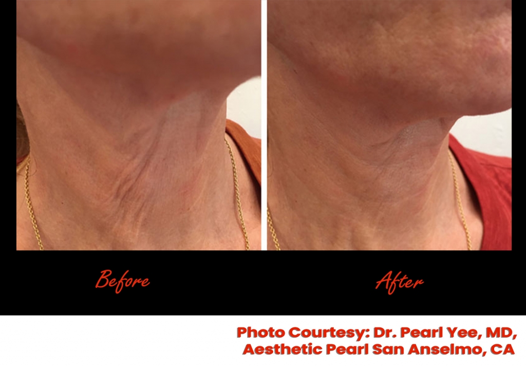 Before & After | Skin Remodeling San Anselmo | Facial Rejuvenation San ...