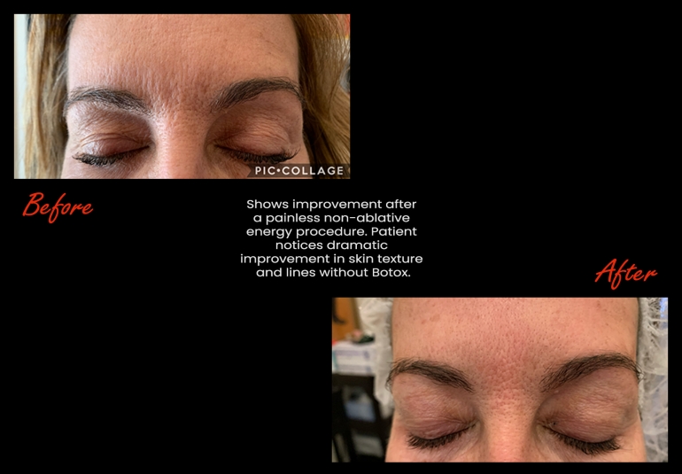 Before & After | Skin Remodeling San Anselmo | Facial Rejuvenation San ...