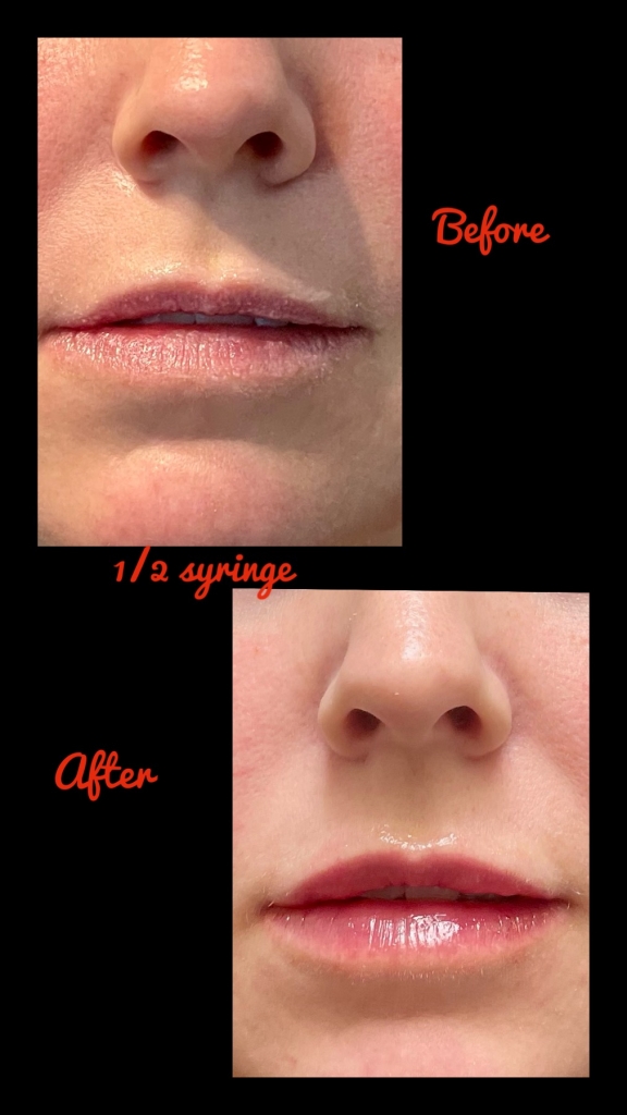 Before & After | Skin Remodeling San Anselmo | Facial Rejuvenation San ...